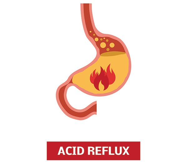 WHAT IS ACID REFLUX? - Dr Sachin Palnitkar